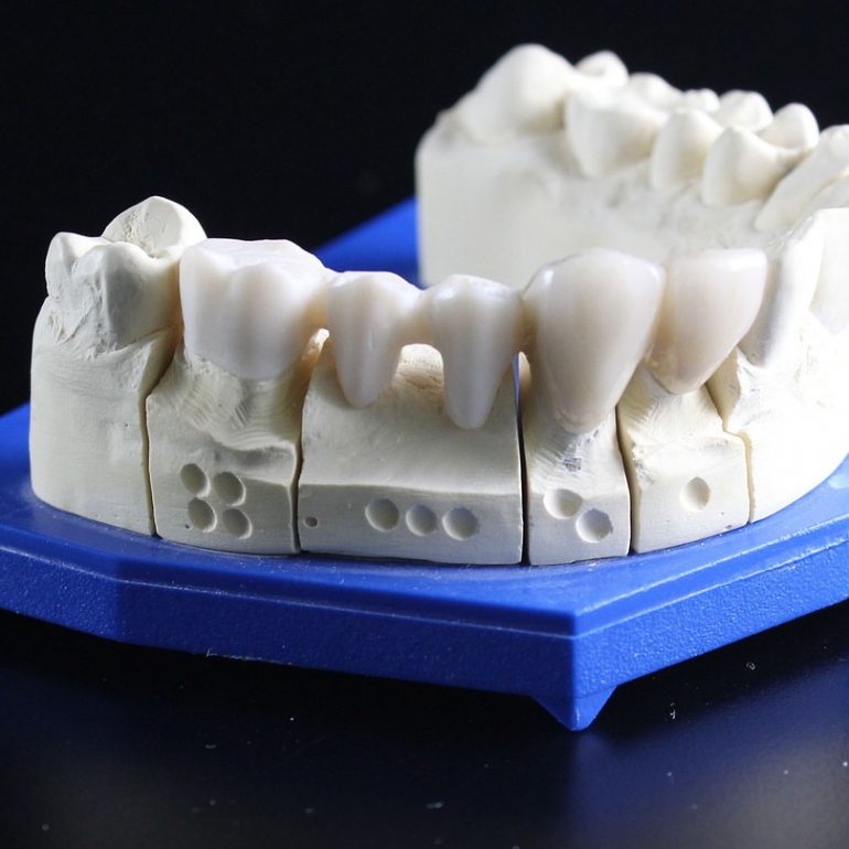 Dientes frágiles: Por qué se rompen y cómo evitarlo